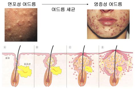 닥터칼럼 커뮤니티 차앤박피부과