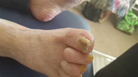 Case Study Subungal Abscess