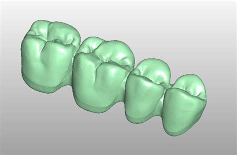 Stl File Flexible Partial Denture Upper Base Artificial Teeth 🦷・3d