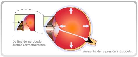 Glaucoma