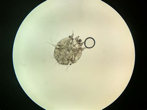 Scabies Infestation Reported At Prince Georges County Firehouses Wtop News