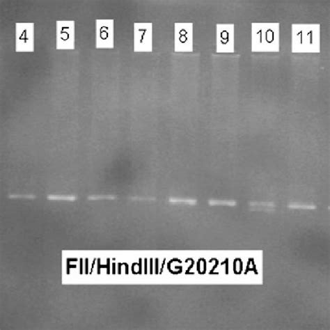 Detection Of Factor V Leiden Gene Mutation G1691a By Polymerase Chain Download Scientific