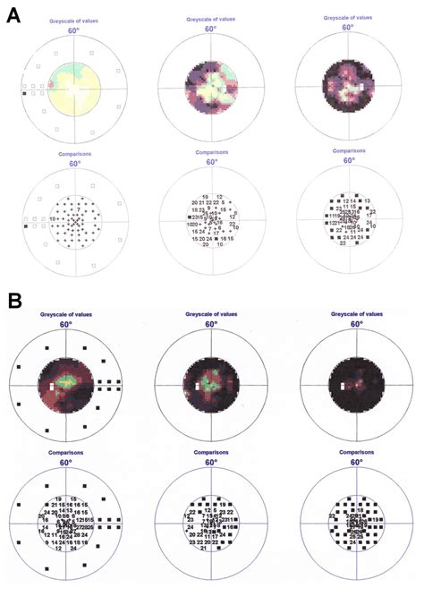 Automated Static Perimetry Octopus 101 ® Serial Exams In A Right Download Scientific