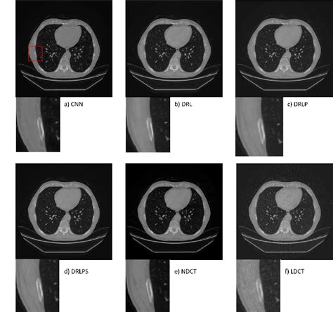 Figure From Low Dose CT Denoising Using Dilated Residual Learning With Perceptual Loss And