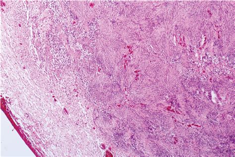 Patients Histopathology Encapsulated Biphasic Spindle Cell Neoplasm Download Scientific