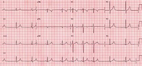 Sick Sinus Syndrome Causes Symptoms Ecg Treatment