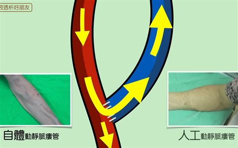 【必看】血液透析：动静脉瘘管照护 Bilibili B站 无水印视频解析——yiuios易柚斯