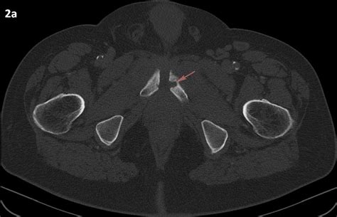 Osteomyelitis Os Pubis Pacs