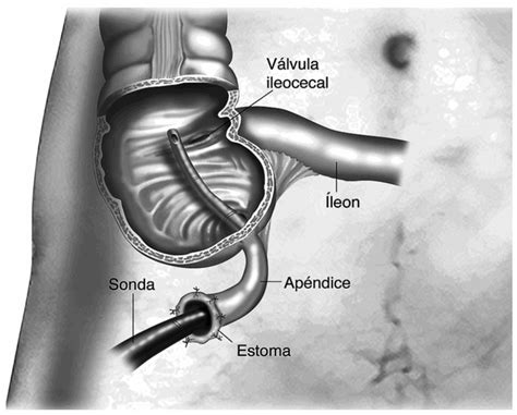 Mace Procedure At Hilda Connor Blog