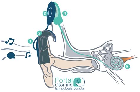 Partes De Um Diagrama De Implante Coclear