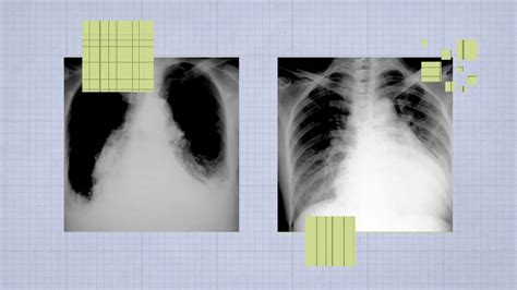 X Ray Chest Heart Chest X Ray