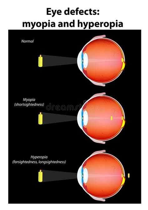 Myopia Stock Illustrations 4984 Myopia Stock Illustrations Vectors