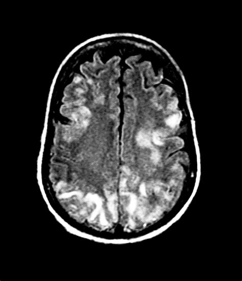 Brain In Toxic Encephalopathy Photograph By Zephyr Pixels
