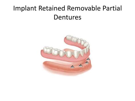 Solution Implant Retained Removable Partial Dentures Prosthodontics