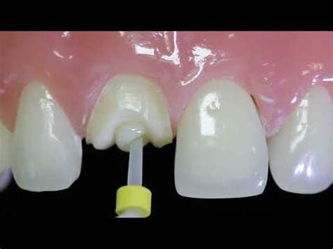 Endodoncia Y Poste De Fibra De Vidrio Recupera La Fortaleza Y Estética