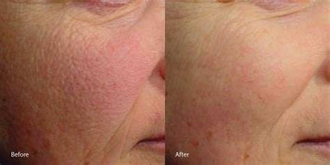 Laser Genesis Before And After Photos The Laser Image Company