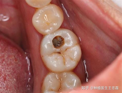 晚上刷牙比早上刷牙更重要？那我早上的牙不是白刷了吗？ 知乎