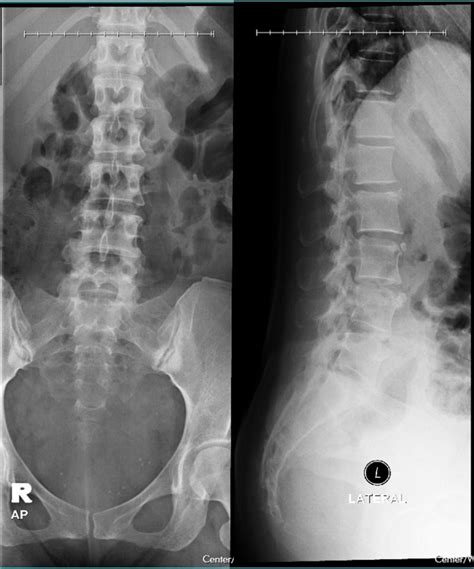 Osteitis Condensans Ilii Causes Osteitis Condensans Ilii Including