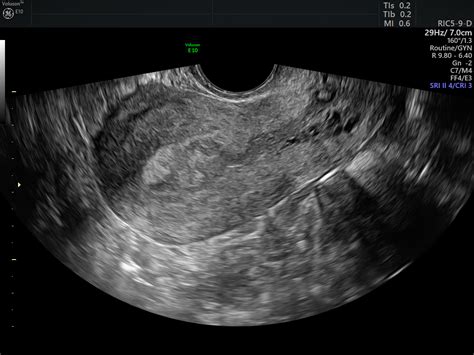 Detecting Endometrial Carcinoma With Ultrasound Empowered Womens Health