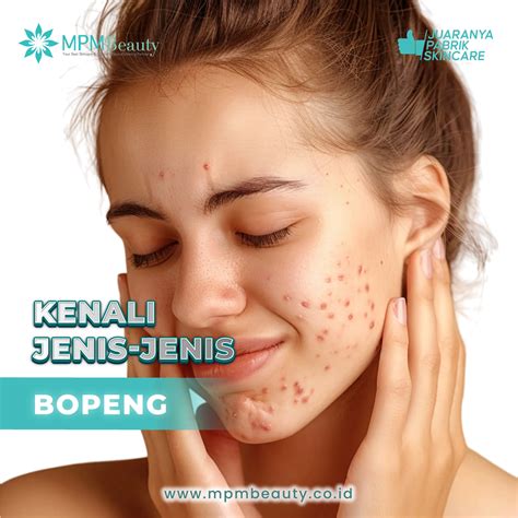 Kenali Jenis Jenis Bopeng