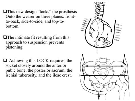 Hip Disarticulation Ppt Free Download