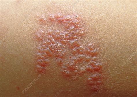 Shingles Stock Image C0129688 Science Photo Library