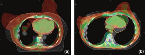 Image Fusion Of The Ct Scans Acquired In The Prone Versus The Supine Download Scientific