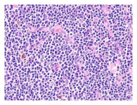 Diagnostic Workup Of Small B Cell Lymphomas A Laboratory Perspective