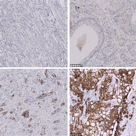 Human Epidermal Growth Factor Receptor 2 Her2 Status By Fish