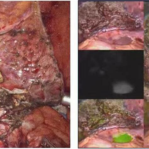 Findings After Laparoscopic Left Hemihepatectomy Llh Left Figure Download Scientific