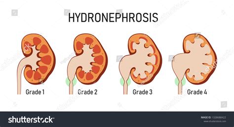 Hydronephrosis Stage Vector Illustration Stock Vector Royalty Free 1328688422 Shutterstock
