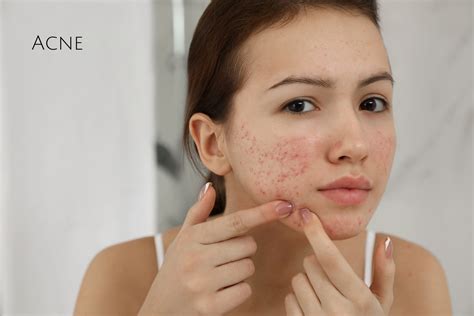 9 Skin Diseases That Require A Dermatologists Advice Kiwla