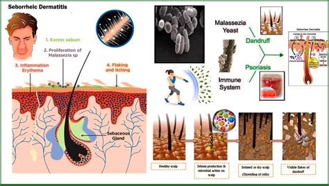 Seborrheic Dermatitis Symptoms Causes Best Homeopathic Treatment Top Medicines