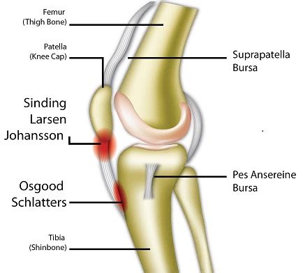 Sinding Larsen Johansson Disease Larsen Sinding Johansson Orthobullets