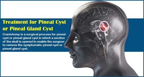 Pineal Gland Cyst Risk Factors Uxphk