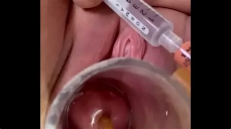 Llorar Mientras El Catéter Atraviesa El Orificio Interno Y Lo Dilata