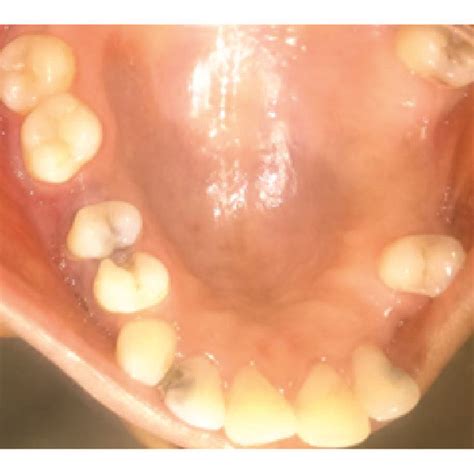 Orthopantomograph Shows Coronal Radiolucency In 14 And 15 With