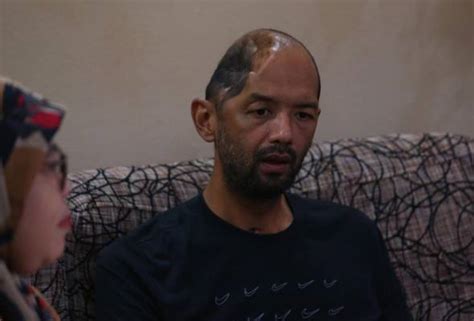 Sufi Selamat Jalani Pembedahan Implan Tempurung Kepala Astro Awani