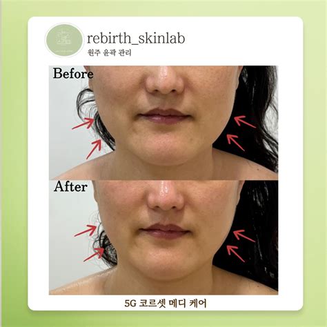 원주여드름관리 L 단구동피부관리 L 리버스스킨랩 여드름 재생 필링 1회로 붉음증 완화 피지량도 엄청 많이 줄었는데 사진으로 보이지 않네요 😭 빠른 여드름 개선을