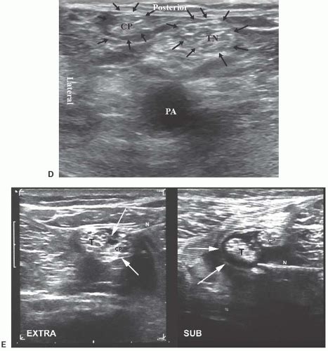 Ultrasound Guided Popliteal And Lateral Sciatic Block Anesthesia Key