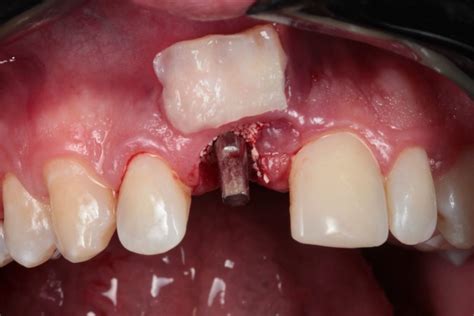 Immediate Implant With Immediate Provisioning And Connective Tissue Graft A Case Report Fgm