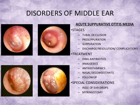 Perforated Eardrum Otitis Media At Joshua Ingram Blog