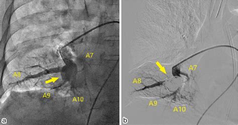 Figure 2 From Successful Intrasaccular Coil Embolization Of Mycotic Figure 2 From Successful Intrasaccular Coil Embolization Of Mycotic