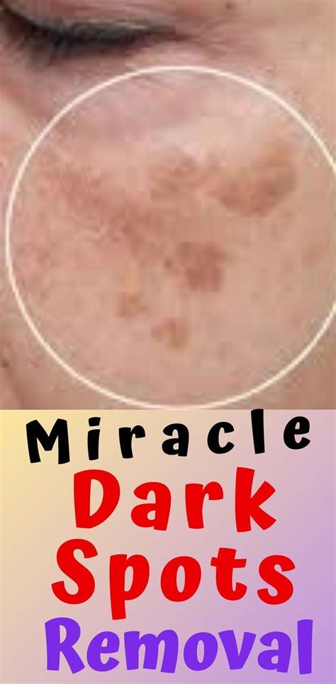 Effective DIY Methods To Remove Dark Spots