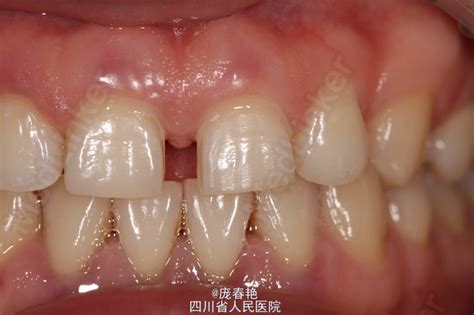 贴面关闭中切牙间隙一例 医联