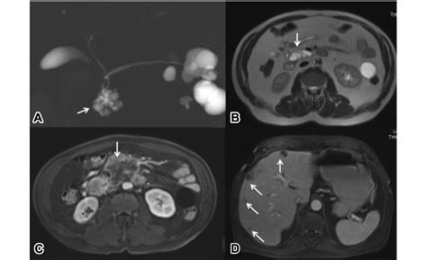 Degenerated Ipmn At Mrcp A Bd Ipmn Is Appreciable In The Uncinate Download Scientific Diagram