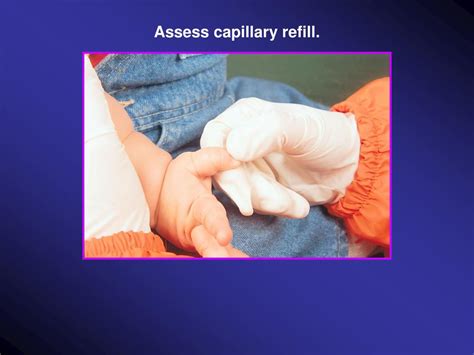 How To Check Capillary Refill Time In Neonates At Arthur Lawrence Blog