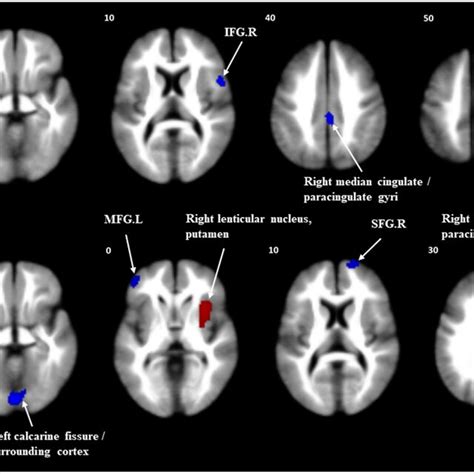 Meta Analysis Of Regional Abnormal Resting State Brain Activities In