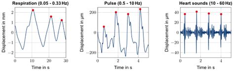 Radar Based Vital Sign Detection