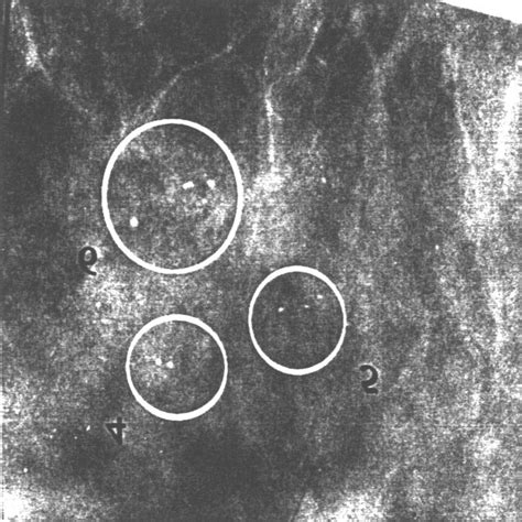 Example Of Real And Simulated Clustered Microcalcifications 4 Real